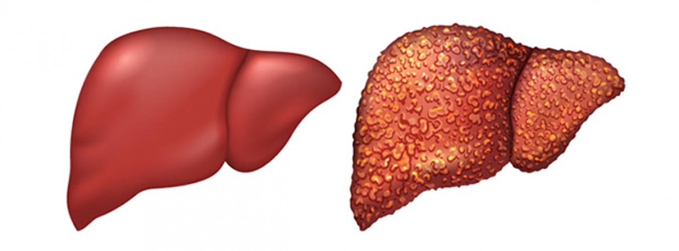 Differentiating Acute and Chronic Liver Diseases | CME Learning Center ...