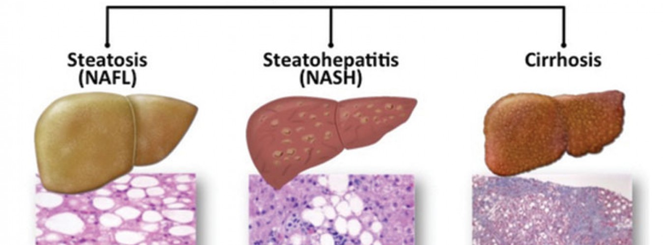 Non-Alcoholic Fatty Liver Disease | CME Learning Center | CME Learning ...