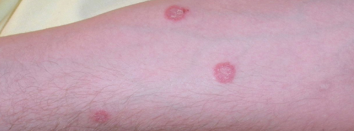 Tinea Corporis Infection a Case-Based Management Approach | CME ...