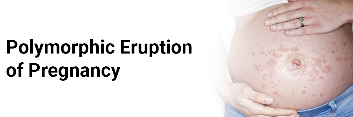 Polymorphic Eruption Of Pregnancy