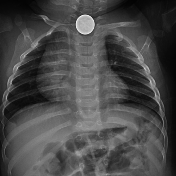 Aortoesophageal Fistula Following Button Battery Ingestion by a Child