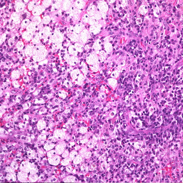 Xanthogranulomatous Salpingo-oophoritis: A case report