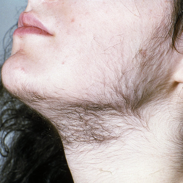 Laser Therapy for Women With Polycystic Ovary Syndrome-Associated Hirsutism