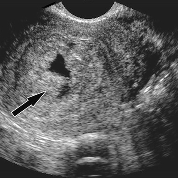 Ultrasonographic and histopathological findings depicting endometrial ...