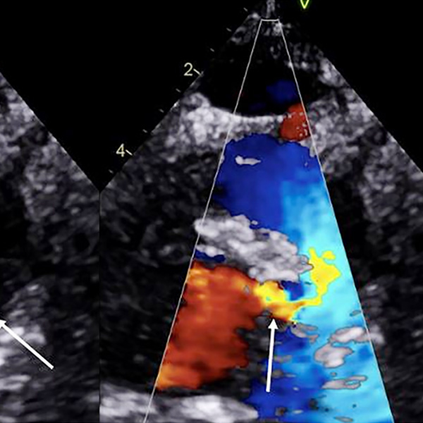 Incidence of Cardiorespiratory Instability Following Closure of ...