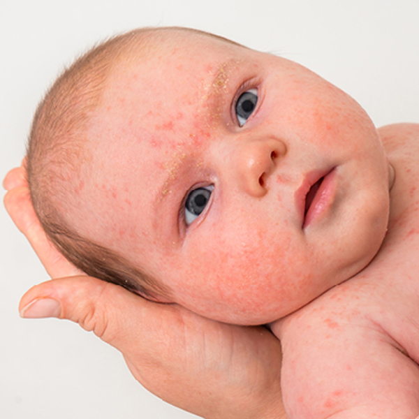 Preclinical Atopic Dermatitis in Infants