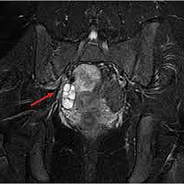 A Rare Case of Hydatid of Morgagni in a Teenager