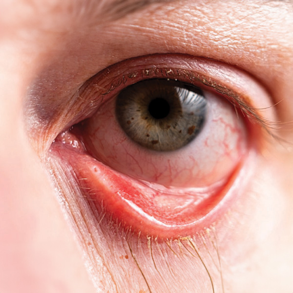 Statin use can heighten dry eye disease risk in hyperlipidemia patients