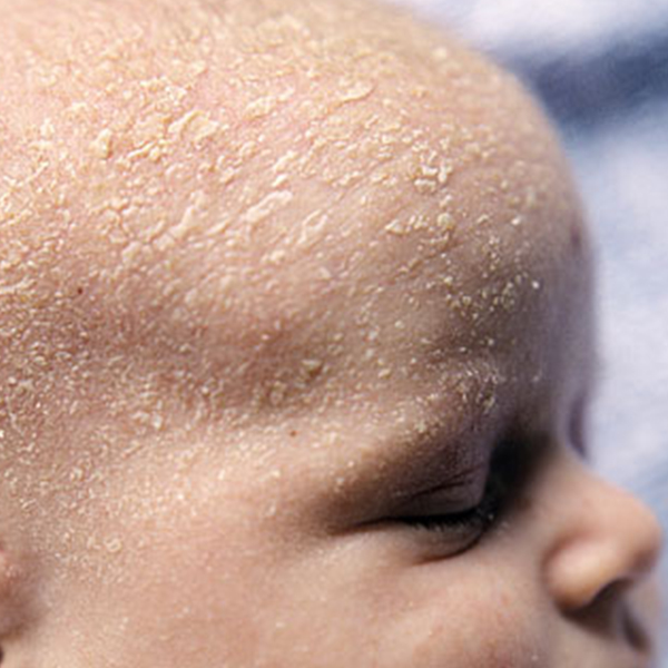 Comparison of Treatments for Infantile Seborrhoeic Dermatitis