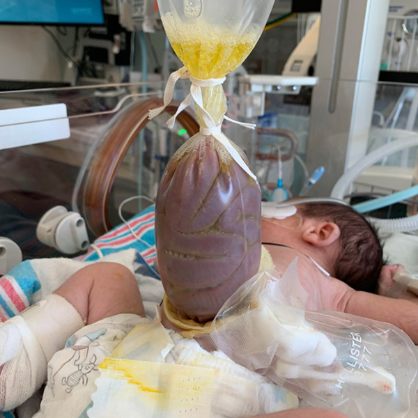 A case report of Management of Ruptured Giant Omphalocele in a Newborn ...