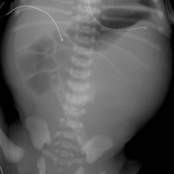 Evaluation of the Modified Martin Procedure for Megacystis Microcolon ...