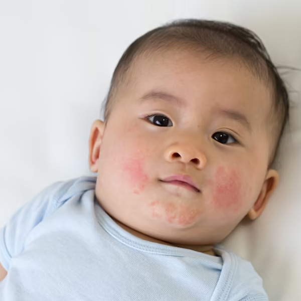 Skin Barrier Matters: A Simple Strategy to Reduce Infantile Atopic ...
