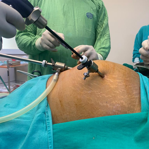 Surgical Management of Bilateral Dermoid Cysts during Caesarean Section