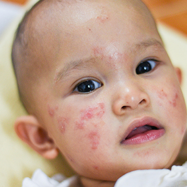 Periorificial Dermatitis in Early Childhood: Insights from a Narrative ...