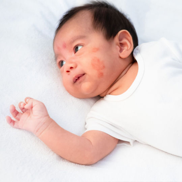 New Review Reveals Gaps in Atopic Dermatitis Guidelines for Children ...