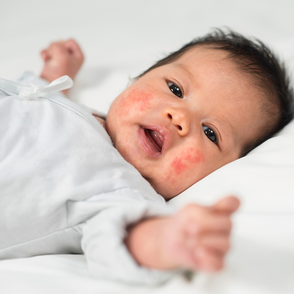 Impact of Pediatric and Adolescent Atopic Dermatitis: Insights From A Real-World Survey