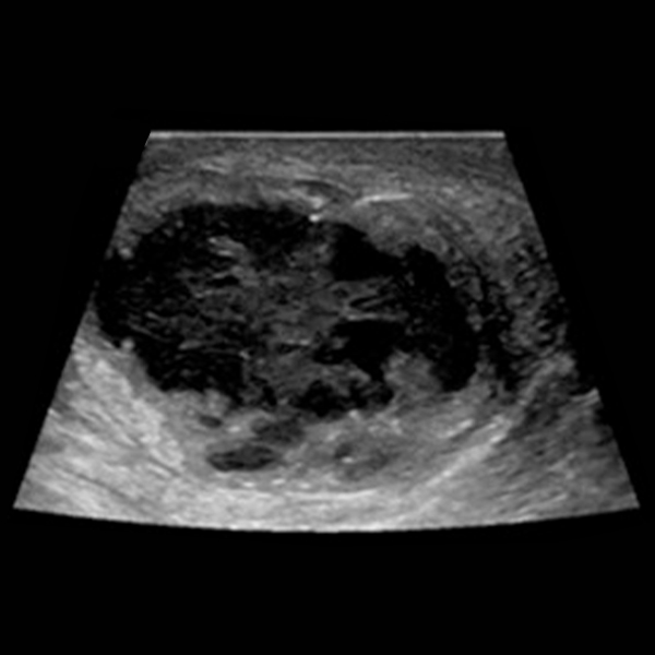 Pediatric Intratesticular Abscess Managed with a Testicular-Sparing ...