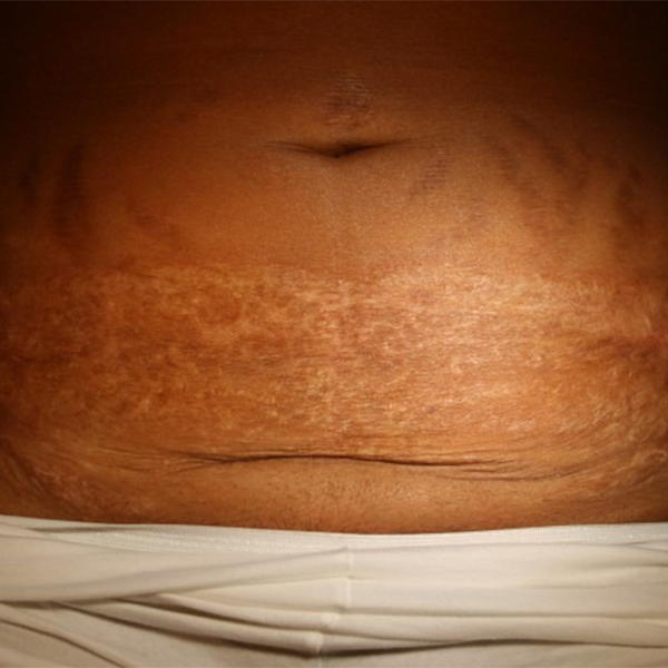 Post-Caesarean Wound Ulceration Due to Pyoderma Gangrenosum