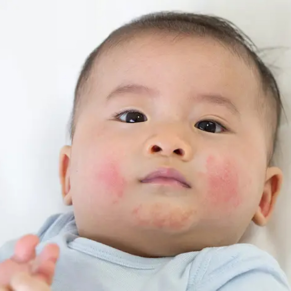 Updated AAP Guidance on Managing Atopic Dermatitis in Children