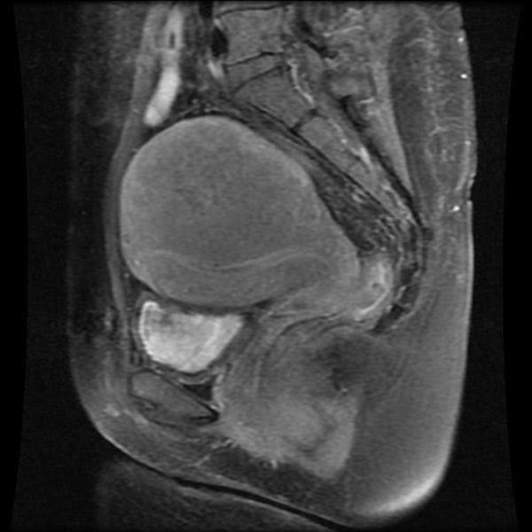 Efficacy of Myomectomy Post-HIFU in Treating Recurrent Uterine Fibroids