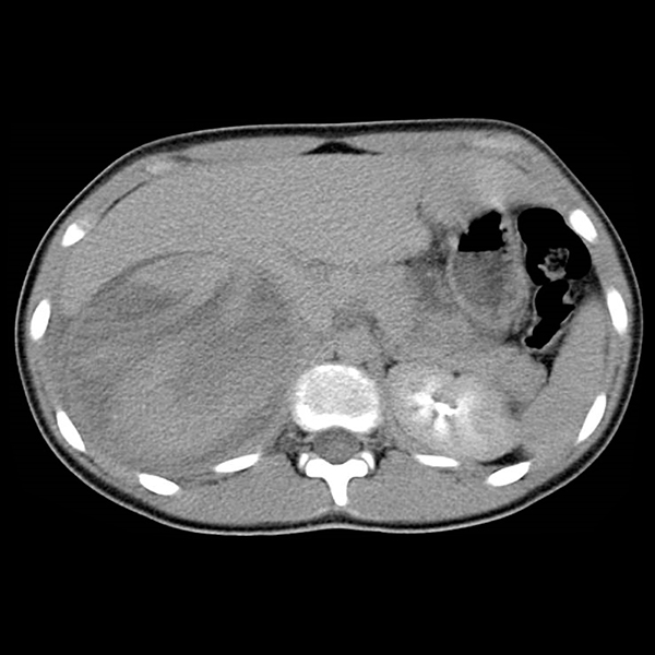 Incidental Findings on Abdominal CT in Pediatric Blunt Trauma: A ...