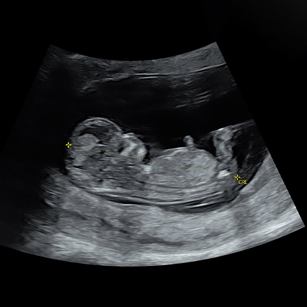 Complex Exomphalos in a Chromosomally Normal Fetus: A Case Report