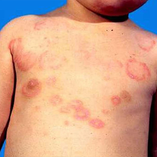Erythema Marginatum In Children