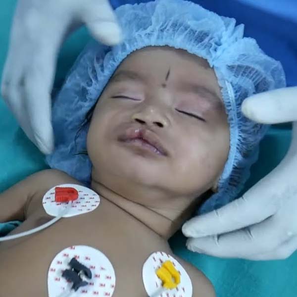 Accuracy of Advanced Pediatric Life Support Intubation Depth Formula in ...