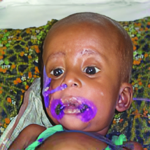 Acute Cheilitis with Oseltamivir