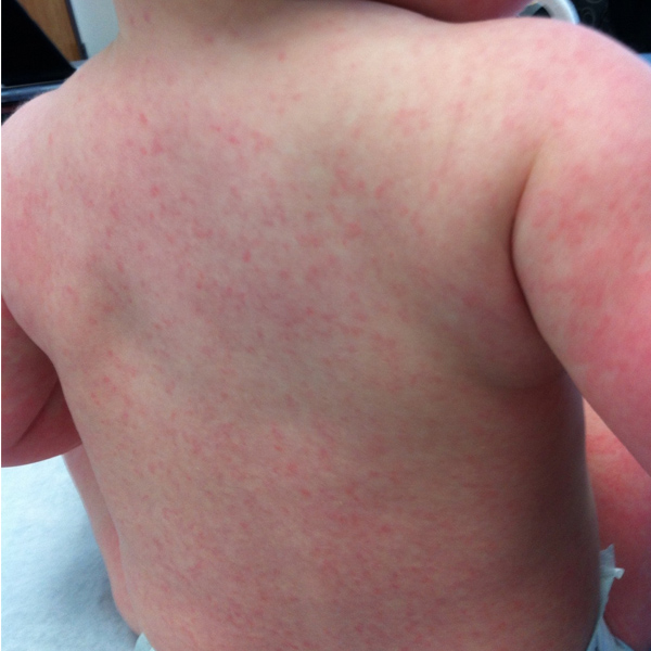 Antibiotic Exposure Increases the Risk of Rash in Children with ...