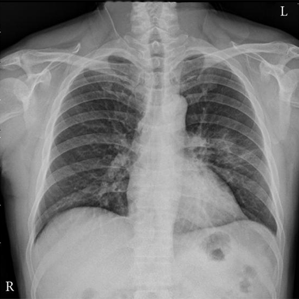 Complicated Acute Pericarditis Caused by Methicillin-Resistant ...