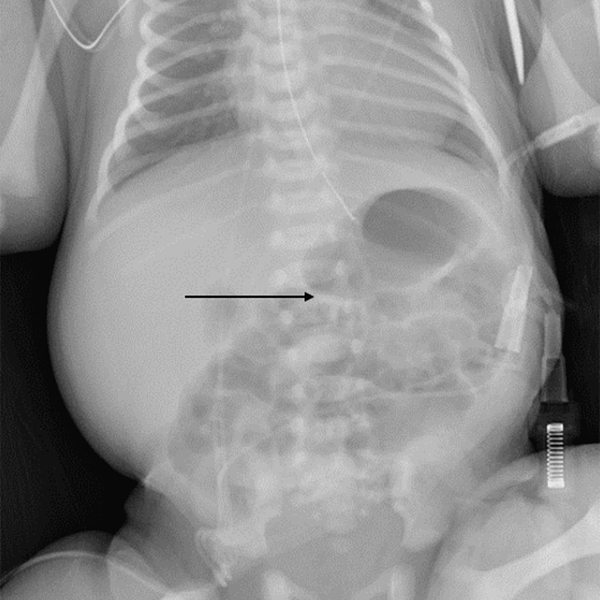 Congenital Duodenal Obstruction Presenting as an Olive-Shaped Abdominal ...