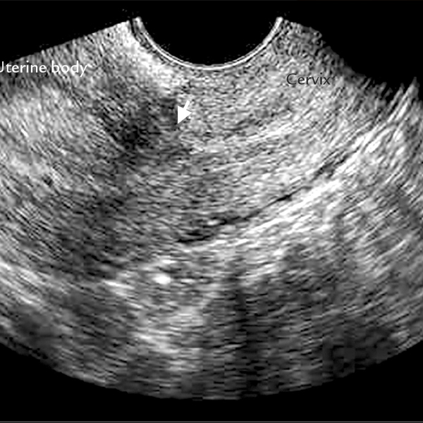 Definition And Sonographic Reporting System For Cesarean Scar Pregnancy