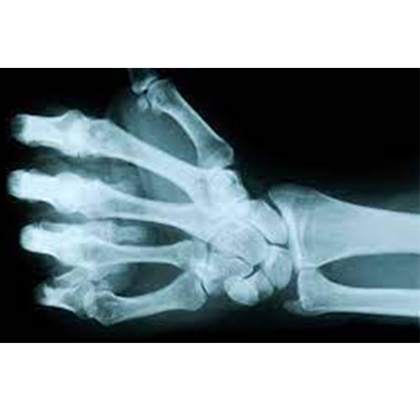 Diabetes, Bone Fragility and Fractures