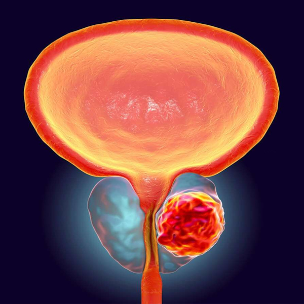 Digital Rectal Exams Solely Aren't Accurate In Detecting Prostate ...