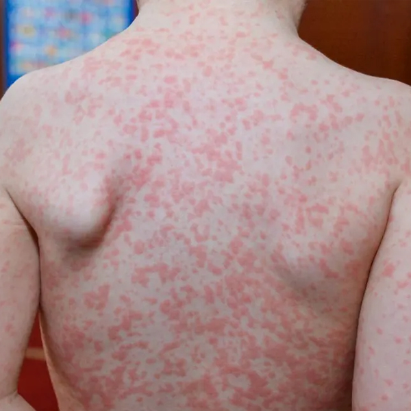 Disseminated life-threatening viral skin rash in a child with AD