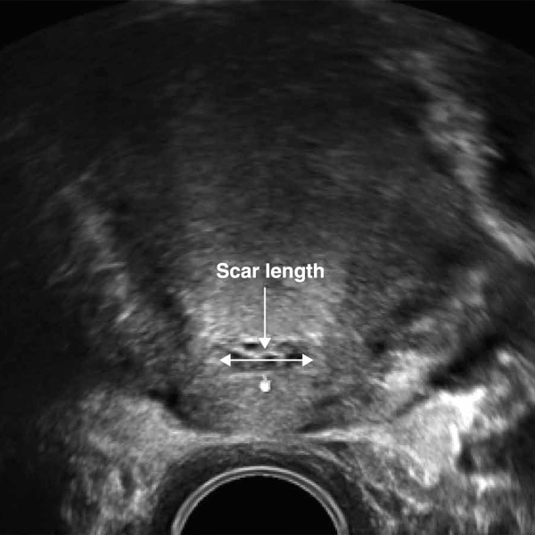 Evaluation of the Urinary Bladder Before Cesarean Delivery in Women ...