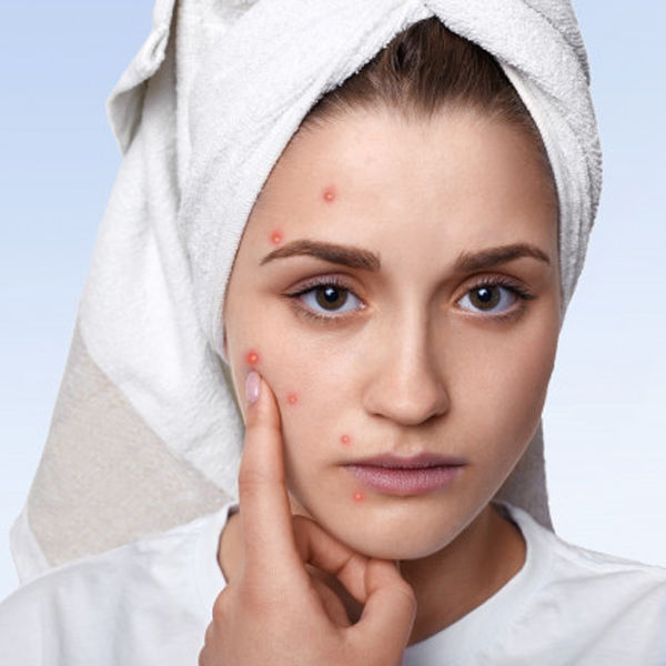 What causes Acne ?Symptoms ,Treatment with Images