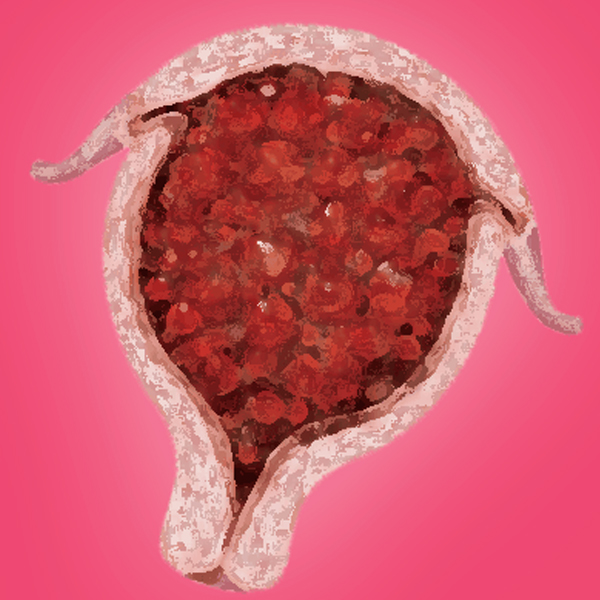 Gestational Trophoblastic Disease: Current Evaluation and Management