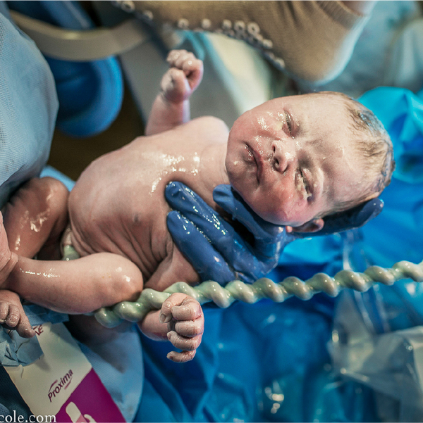 Relationship between umbilical cord arterial blood pH and meconium ...