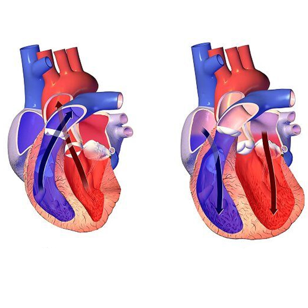 How can we differentiate between Diastolic Dysfunction & Diastolic ...