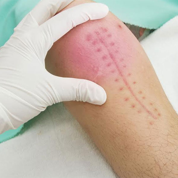 Infection After Knee Replacement Surgery Knee Replacement Surgery