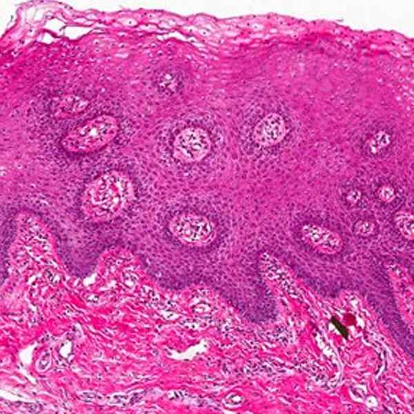 Infantile Perianal Pyramidal Protrusion: Causes, Symptoms & Treatment