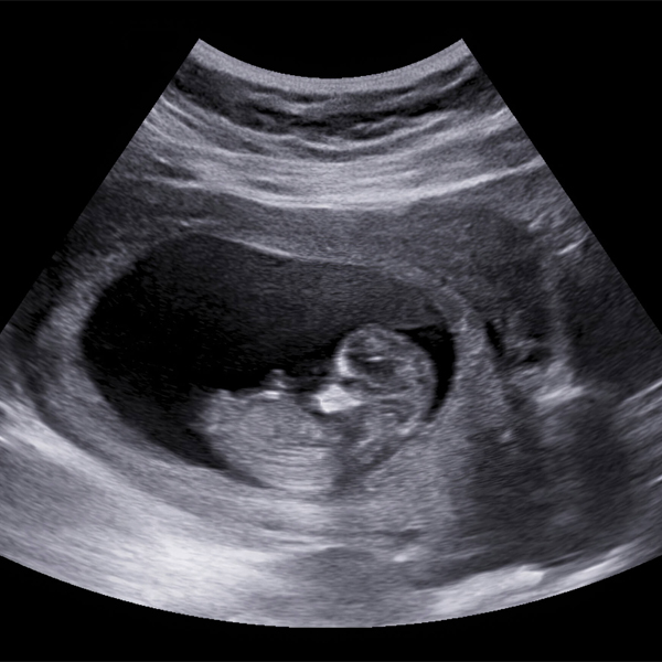 Intramural pregnancy: A case report.