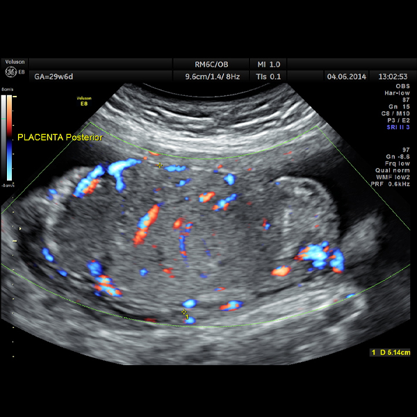 Investigating Placental Abnormalities and Blood Flow in Uteroplacental ...