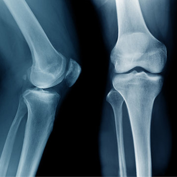 Knee X-Ray: How It Helps in Detecting Joint Abnormalities & Arthritis