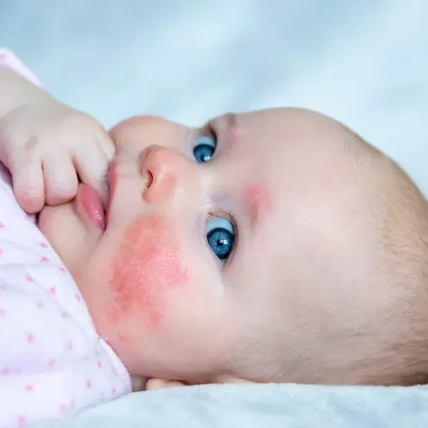 Lower Serum Interleukin-33 Levels in Infantile Atopic Dermatitis