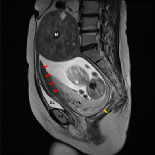 Managing an incarcerated uterus in a gynaecological patient surgically.