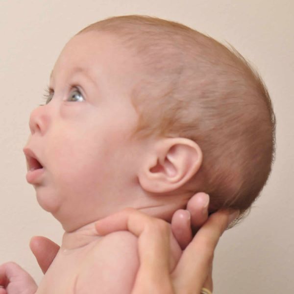 माइक्रोगैनेथिया क्या है? कारण, लक्षण और इलाज | Micrognathia in Hindi