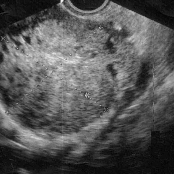 Missed Mixed Germ Cell Tumor Of The Ovary In Pregnancy 3131